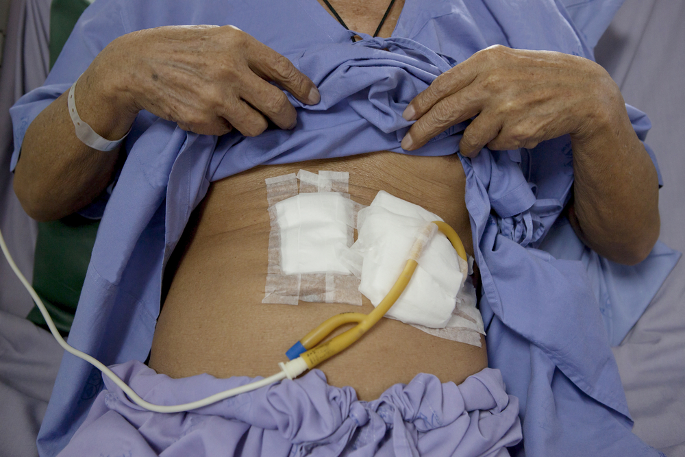 Gastrostomy PEG Feeding ELearning Medex Group